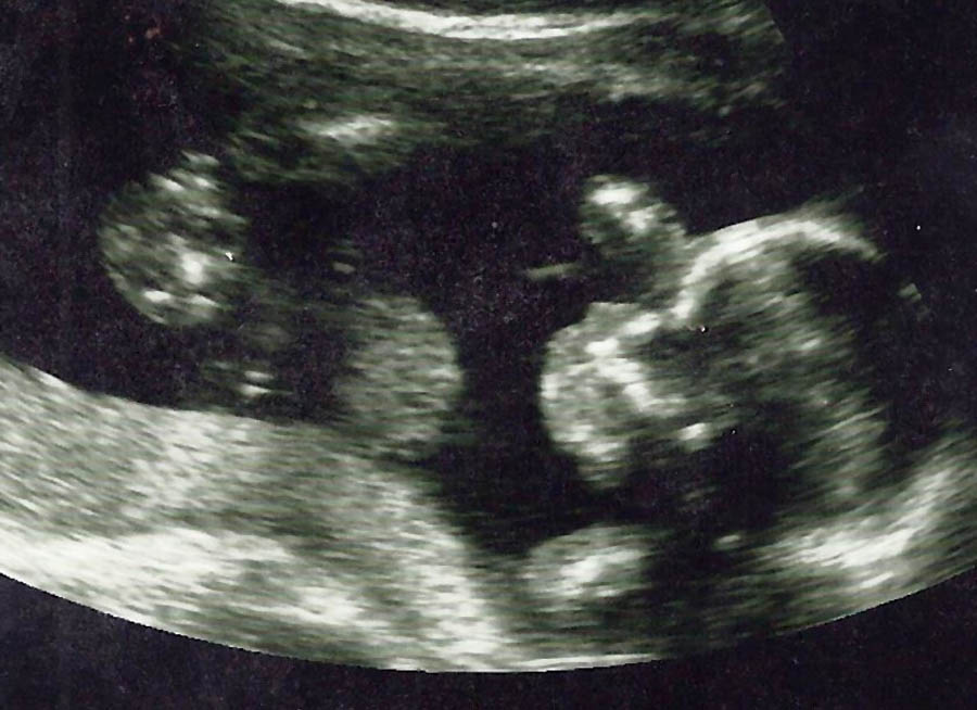 Pregnancy Help News - Judge blocks Iowa heartbeat law